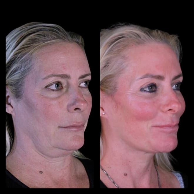 Best Facial Plastic Surgeon for Wethersfield & Hartford, CT – Karter ...