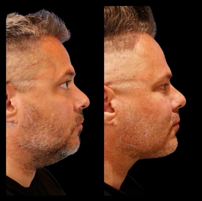 Best Facial Plastic Surgeon for Wethersfield & Hartford, CT – Karter ...